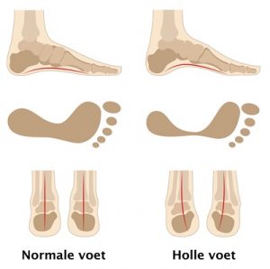 Holle voeten / Pes cavus - PodoXpert | Uw podotherapeut helpt